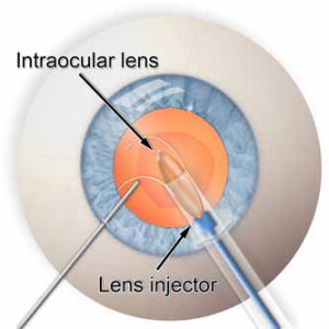 How to Bill Cataract Surgery with IOL Implant ? – Symbiosis Revenue ...